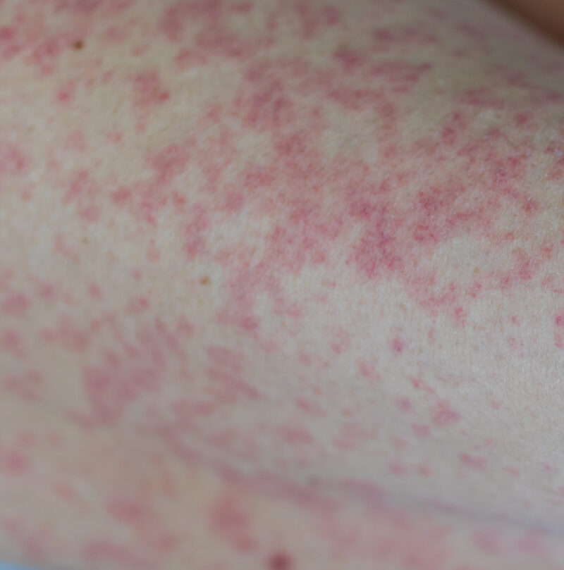 Navigating skin side effects of cancer treatment ~ RSL Revolutionary Labs